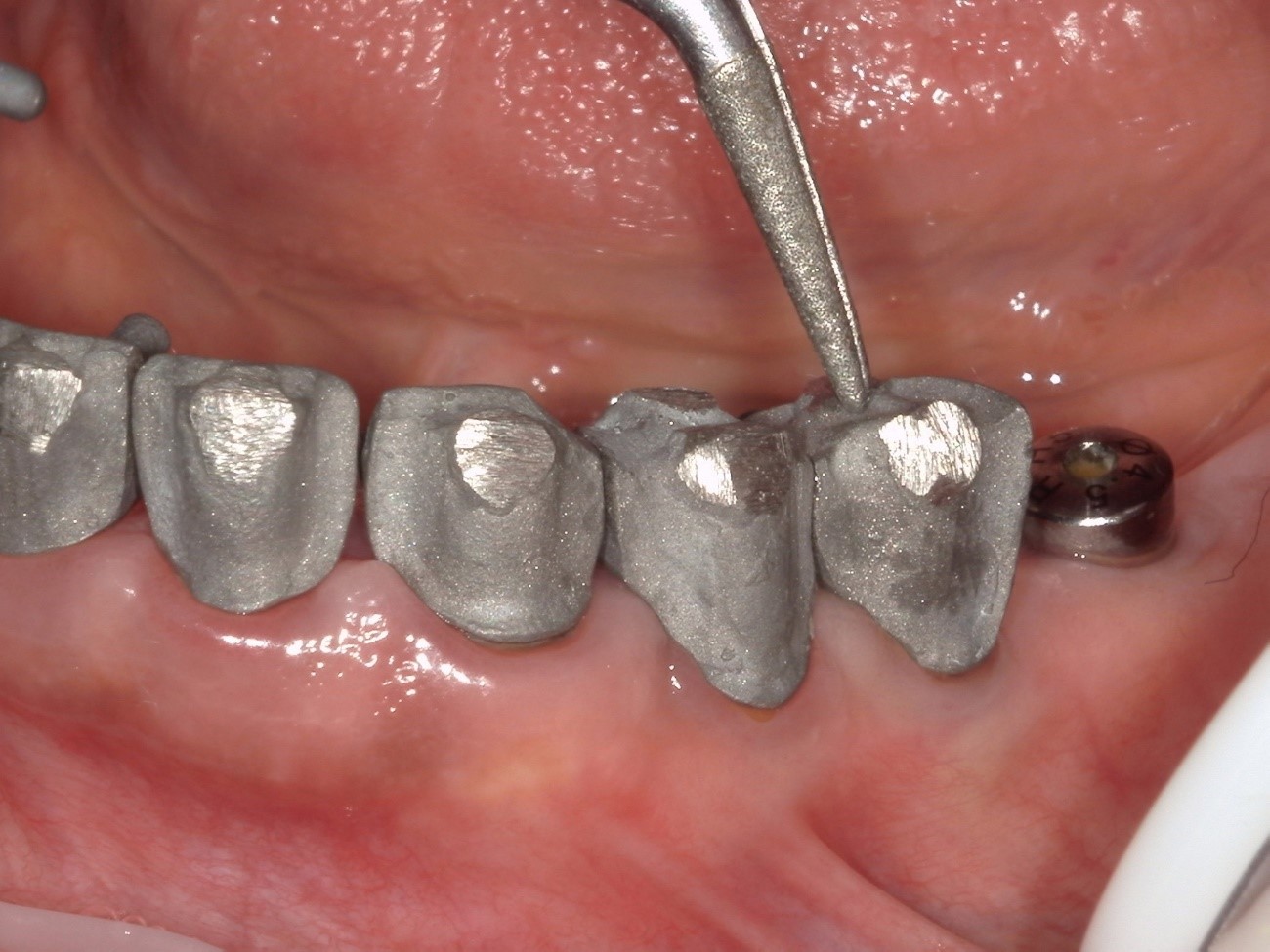 セラミック治療の強度と精度を高めるために必須な2つの方法 | 栃木県佐野市のインプラント・入れ歯なら目黒歯科医院